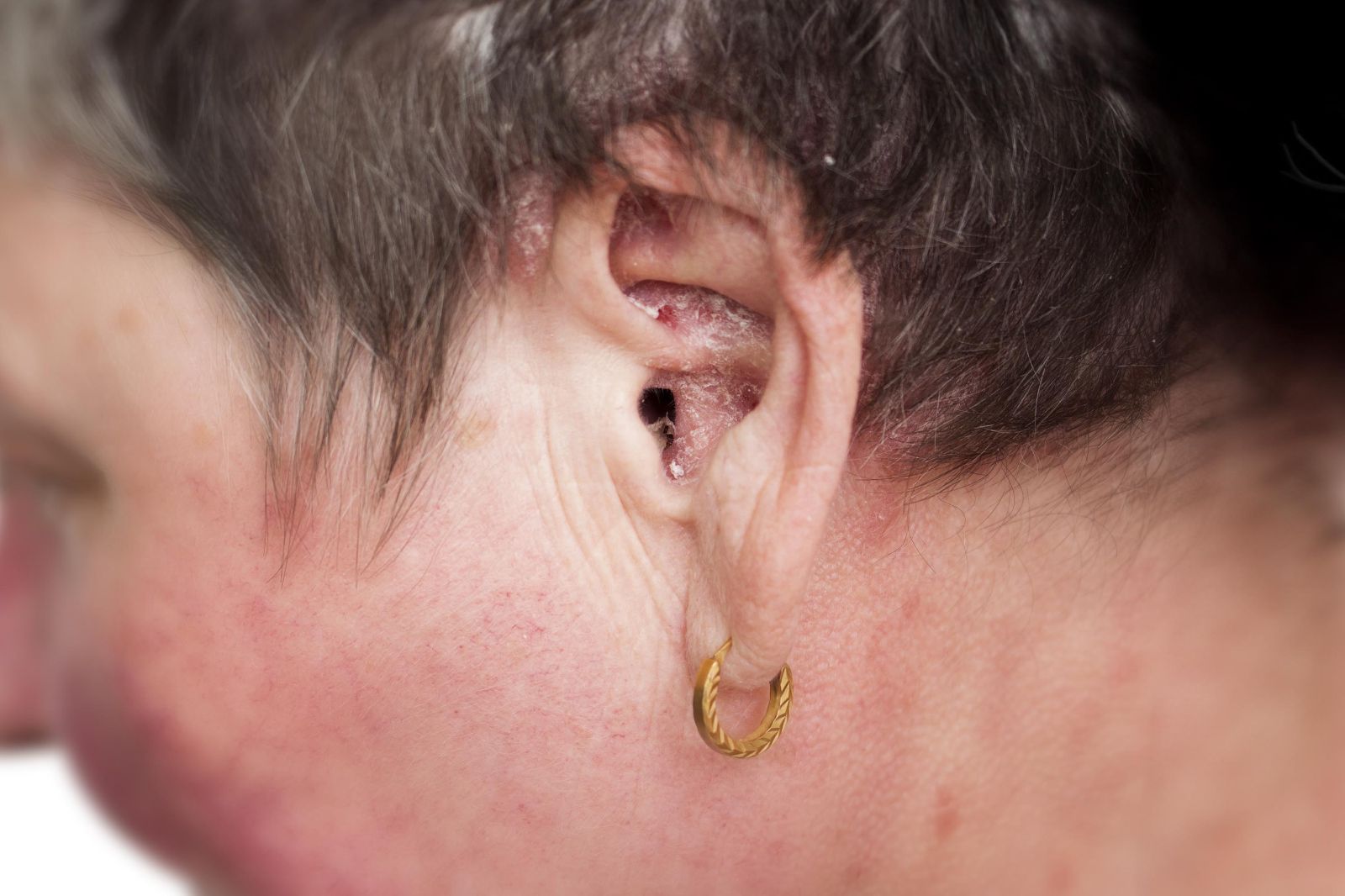 Hydrogen peroxide in ear for cleaning and infections